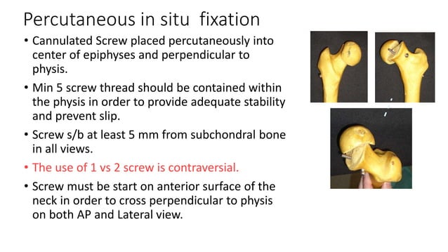 SCFE / slipped capital femoral epiphysis | PPTX | Bone and Joint ...