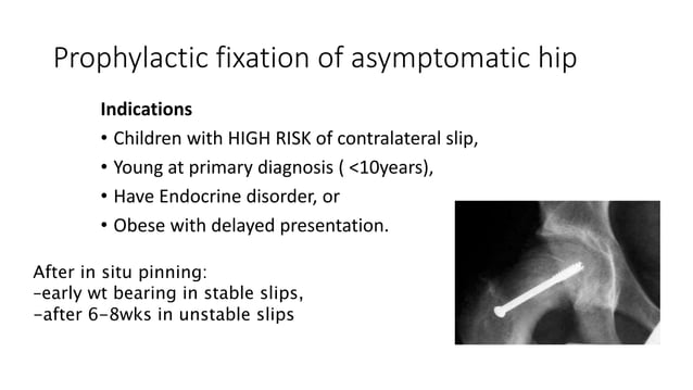 SCFE / slipped capital femoral epiphysis | PPTX | Bone and Joint ...