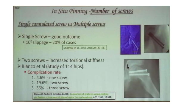 SCFE / slipped capital femoral epiphysis | PPTX | Bone and Joint ...
