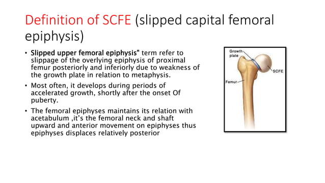 SCFE / slipped capital femoral epiphysis | PPTX | Bone and Joint ...