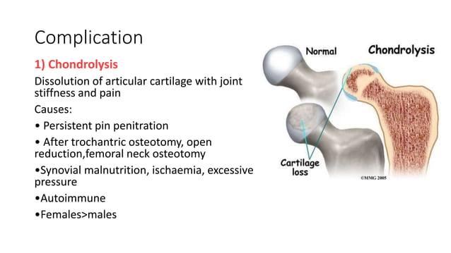 SCFE / slipped capital femoral epiphysis | PPTX | Bone and Joint ...