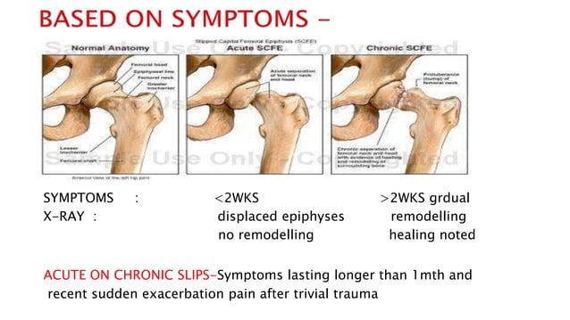 SCFE / slipped capital femoral epiphysis | PPTX | Bone and Joint ...