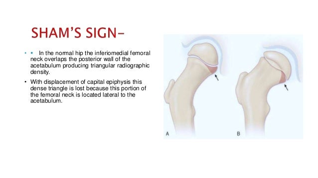 SCFE / slipped capital femoral epiphysis