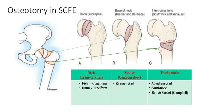 SCFE / slipped capital femoral epiphysis