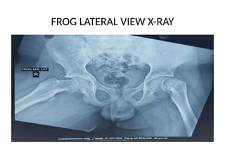 SCFE_Presentation final early management.pptx