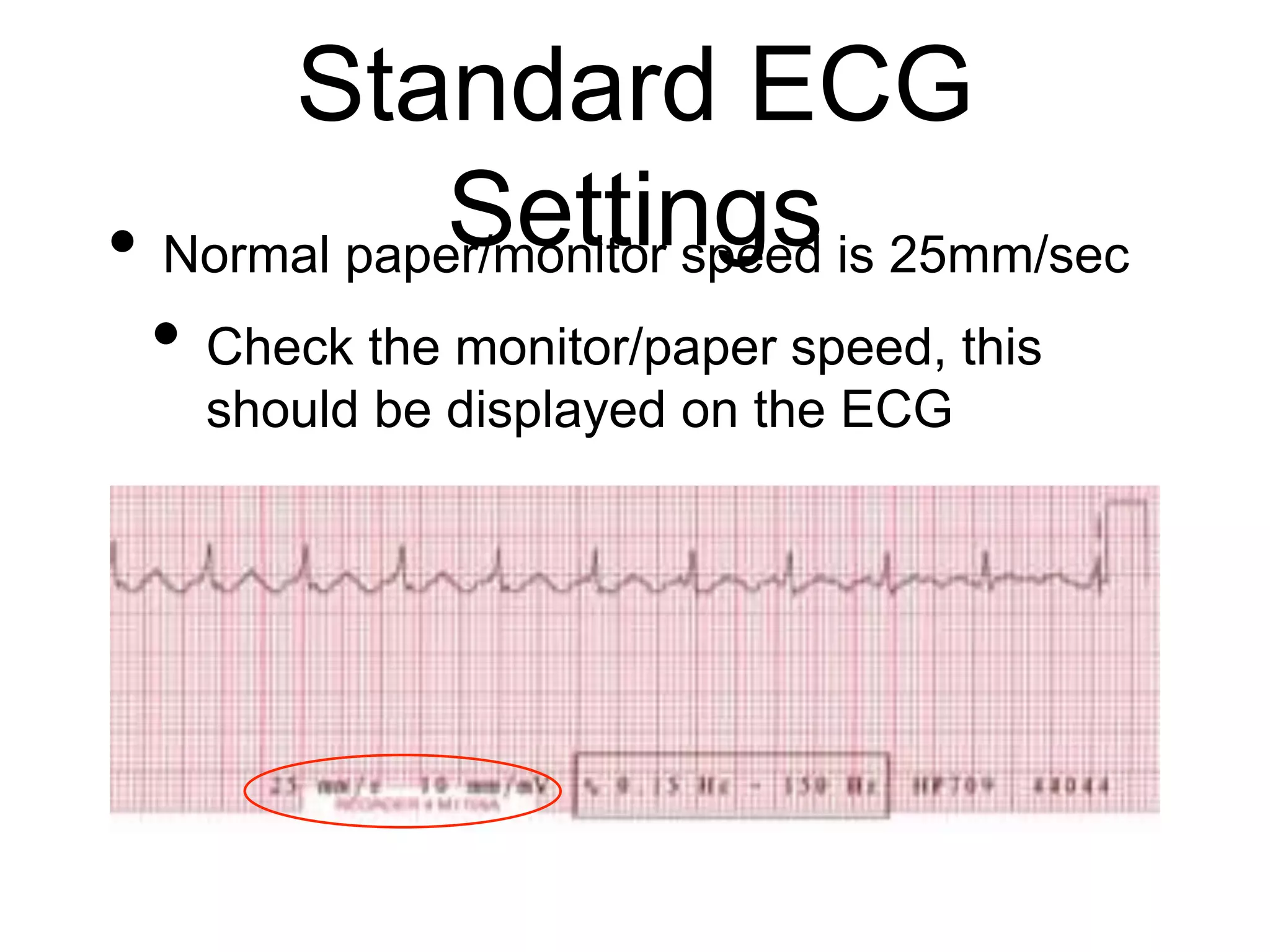 ECG Analysis | PPTX