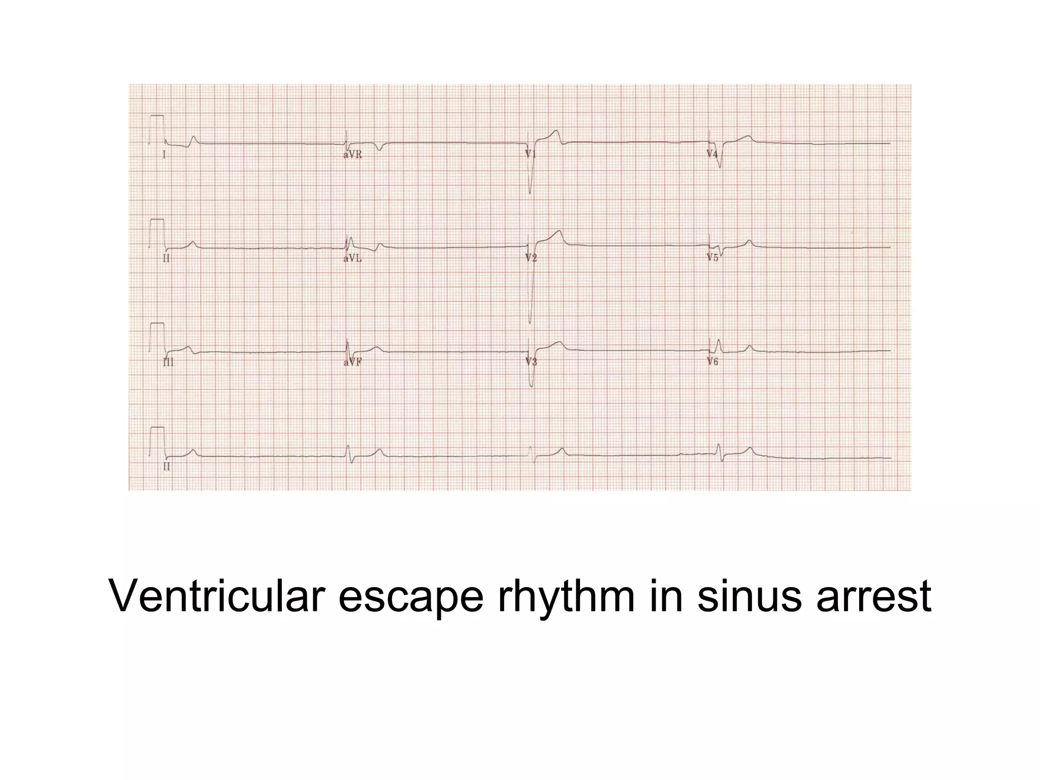 ECG Analysis | PPTX