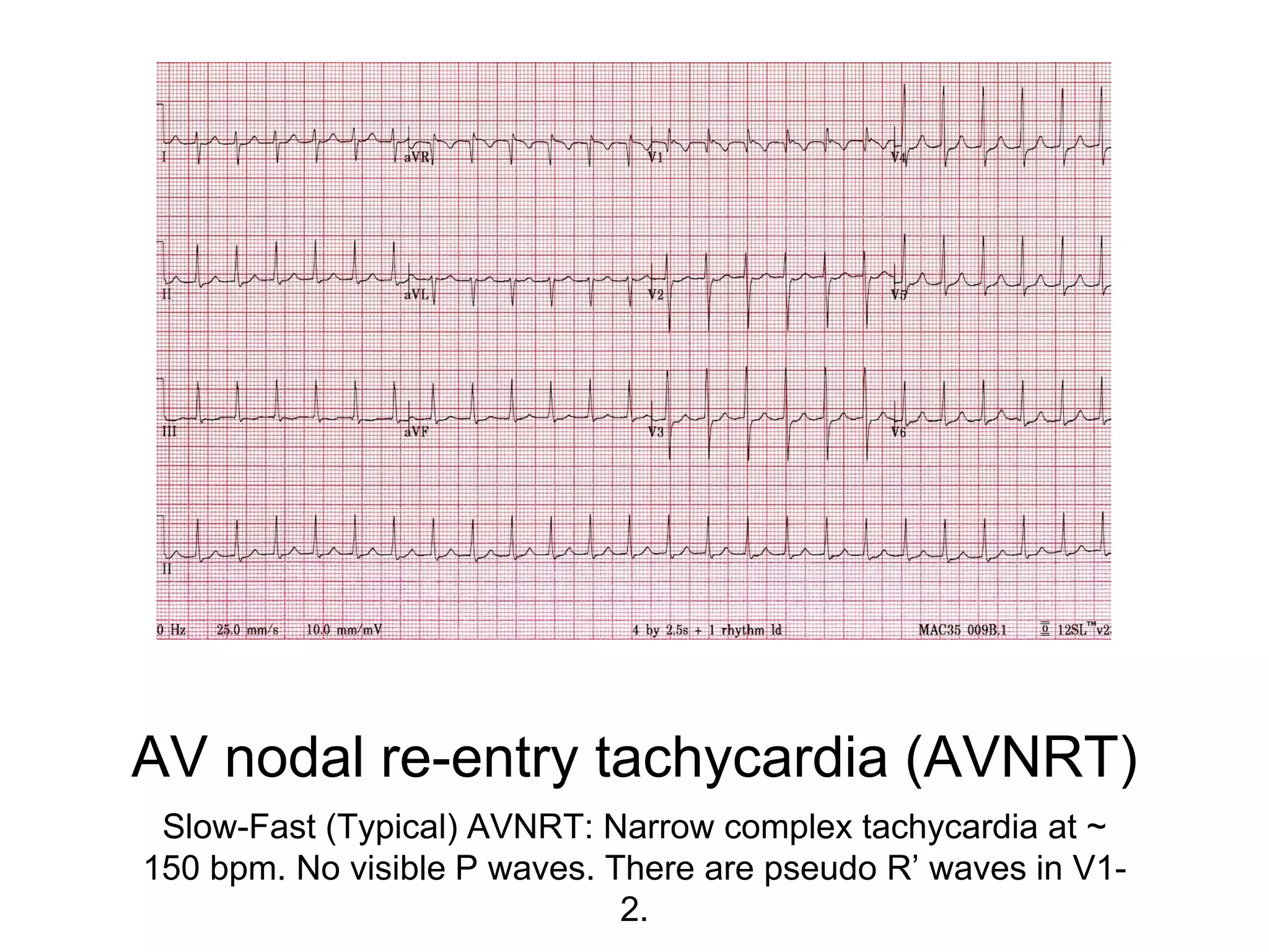 ECG Analysis | PPTX