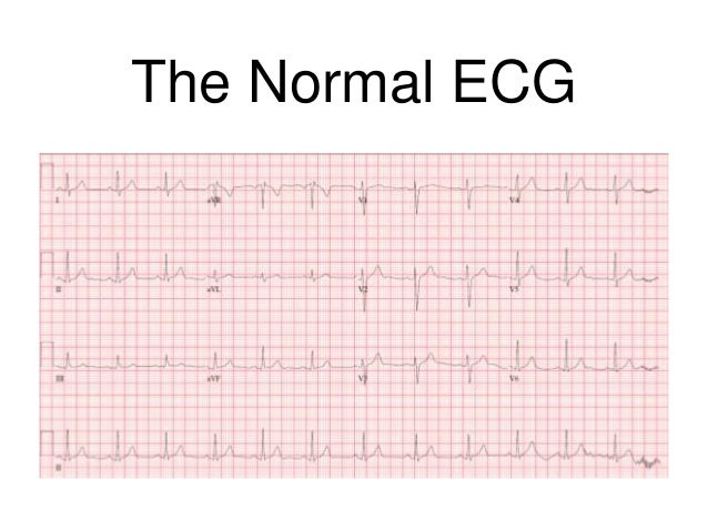 ECG Analysis