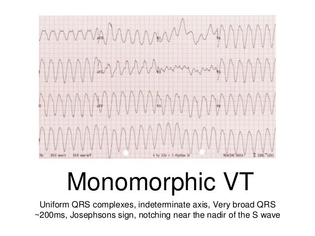 ECG Analysis
