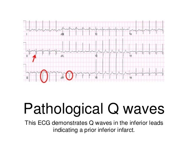 ECG Analysis
