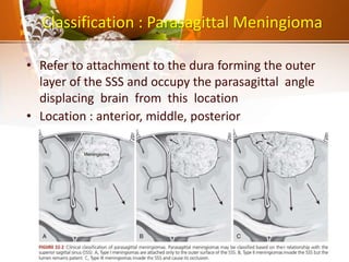 Sch.32 surgical management of parasagittal and convexity meningioma | PPTX