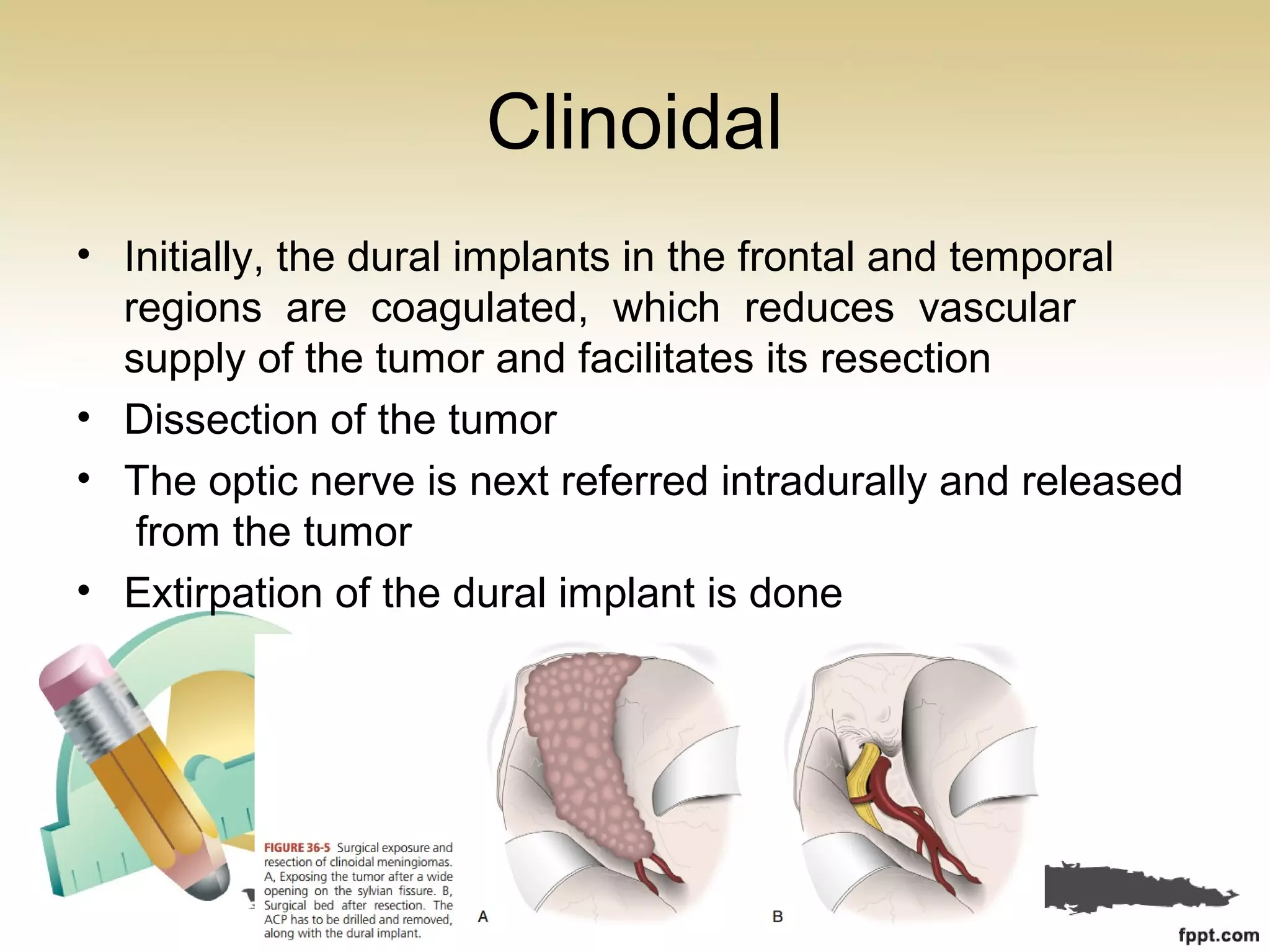 Sch.36 surgical management of sphenoid wing meningioma | PPT
