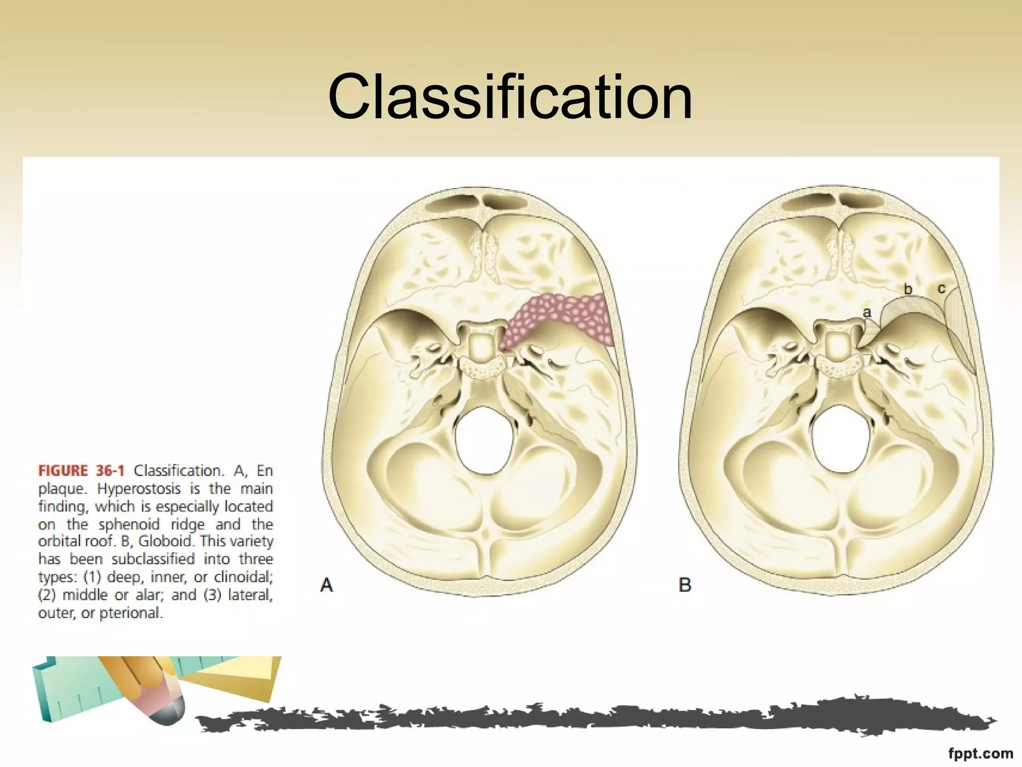 Sch.36 surgical management of sphenoid wing meningioma | PPT
