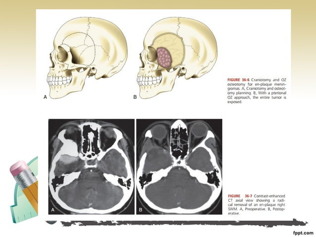 Sch.36 surgical management of sphenoid wing meningioma | PPT | Ear ...