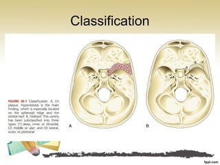 Sch.36 surgical management of sphenoid wing meningioma | PPT