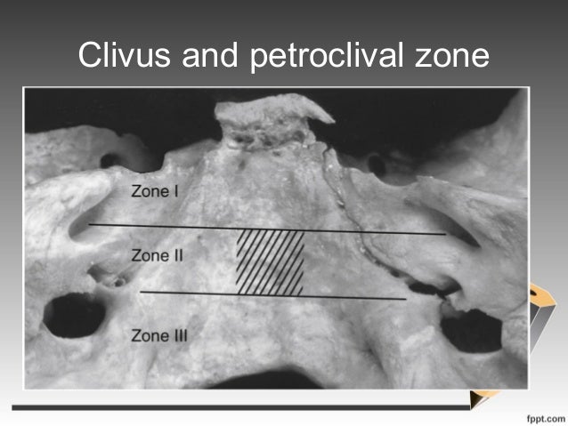 Sch.40 surgical management of petroclival meningioma
