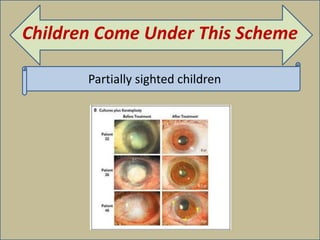 Scheme of integrated education for disabled children | PPTX