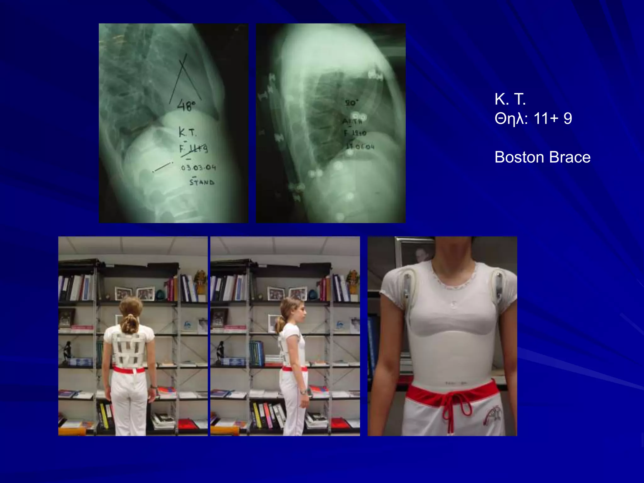 Scheuermann Kyphosis | PPT
