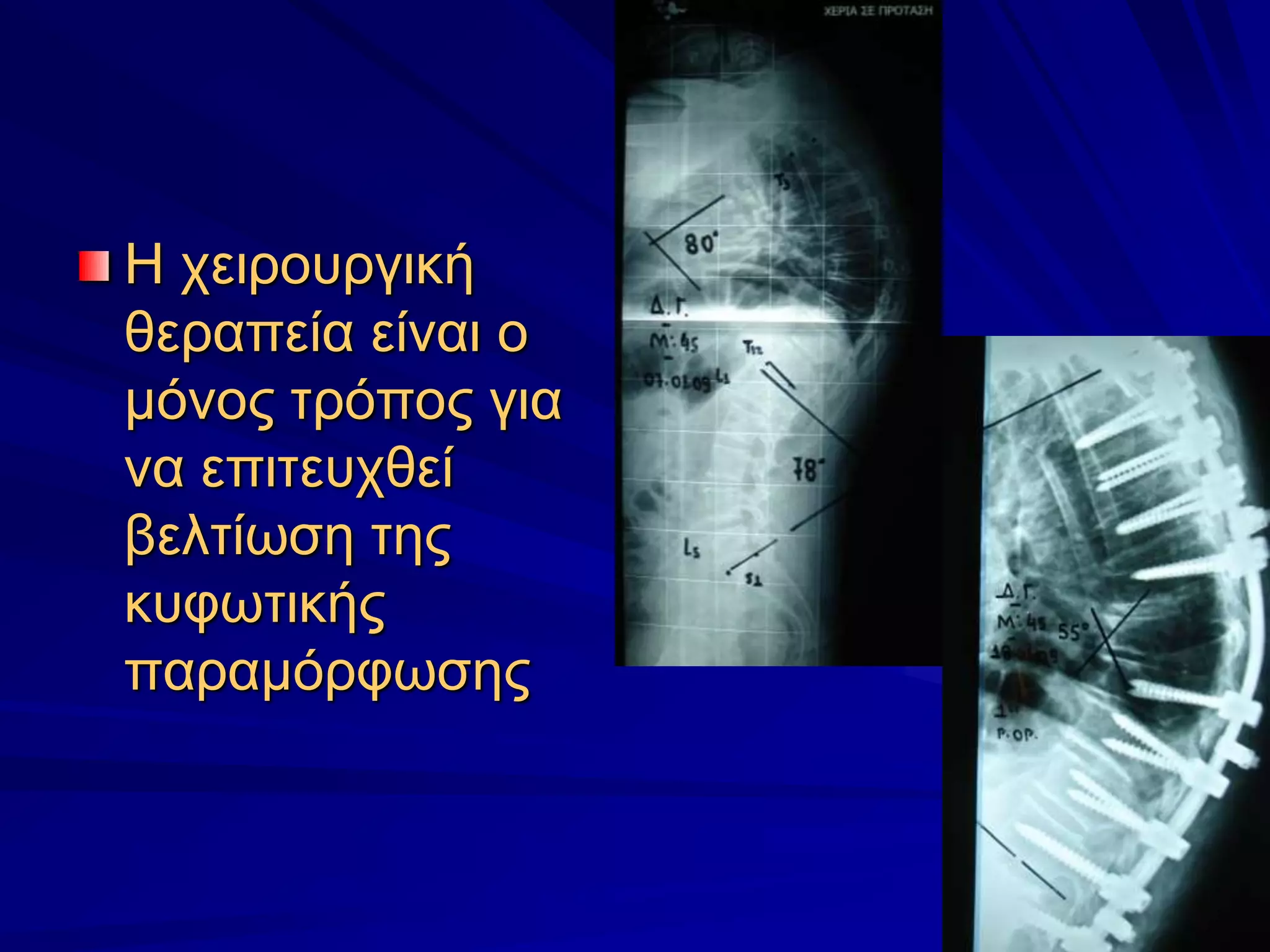 Scheuermann Kyphosis | PPT