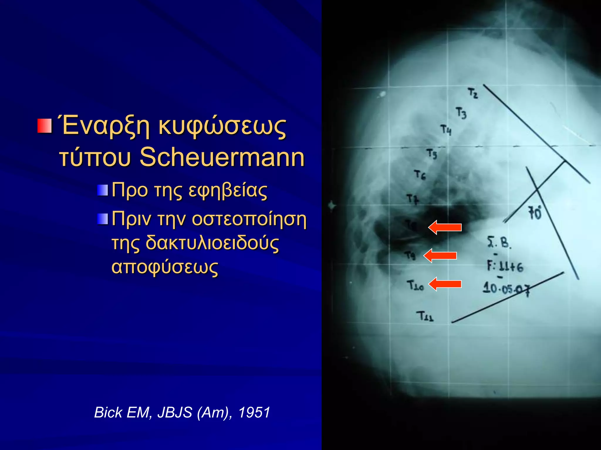 Scheuermann Kyphosis | PPT