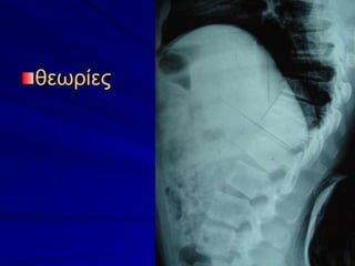 Scheuermann Kyphosis | PPT