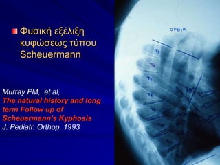 Scheuermann Kyphosis | PPT