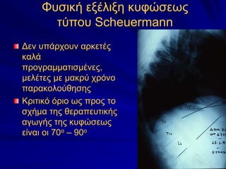 Scheuermann Kyphosis | PPT