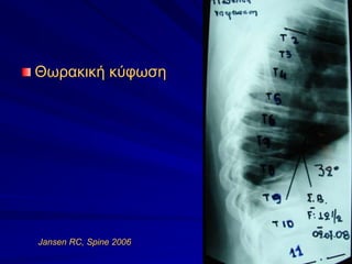 Scheuermann Kyphosis | PPT
