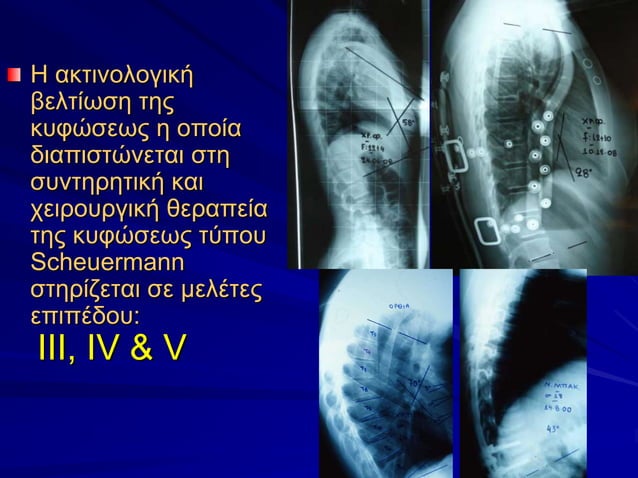 Scheuermann Kyphosis | PPT
