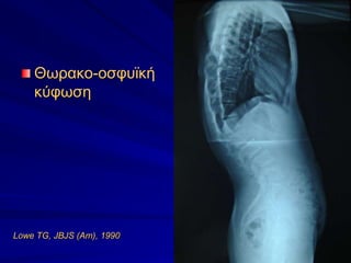 Scheuermann Kyphosis | PPT