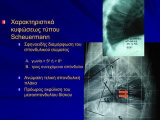 Scheuermann Kyphosis | PPT