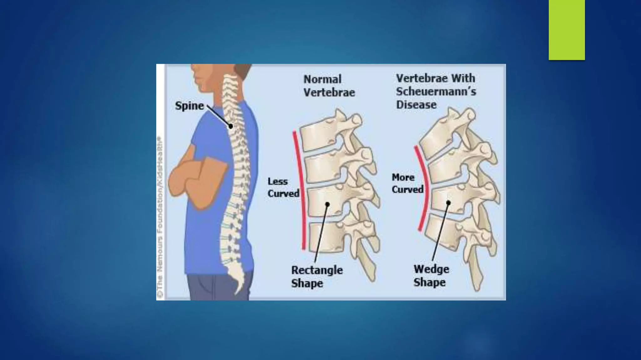 Scheuermann's disease | PPTX