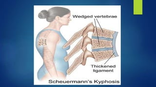 Scheuermann's disease | PPTX