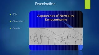 Scheuermann's disease | PPTX