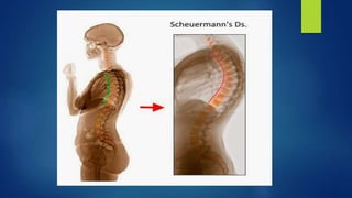 Scheuermann's disease | PPTX