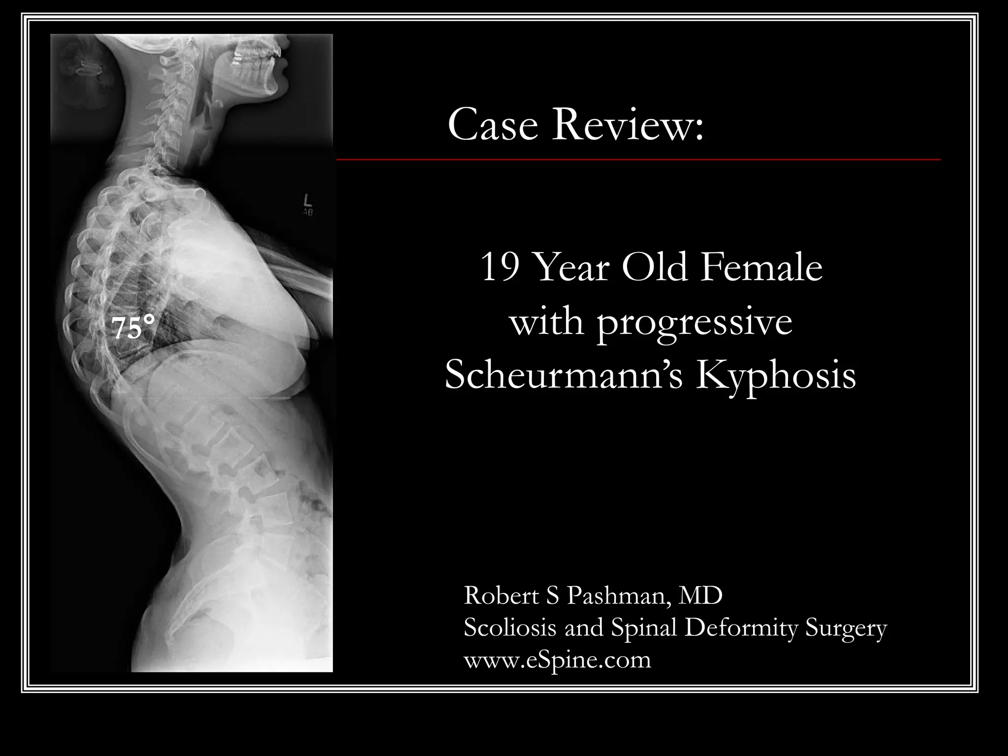 Case Review #9: 19 year old female with Scheuermann's Disease | PPT
