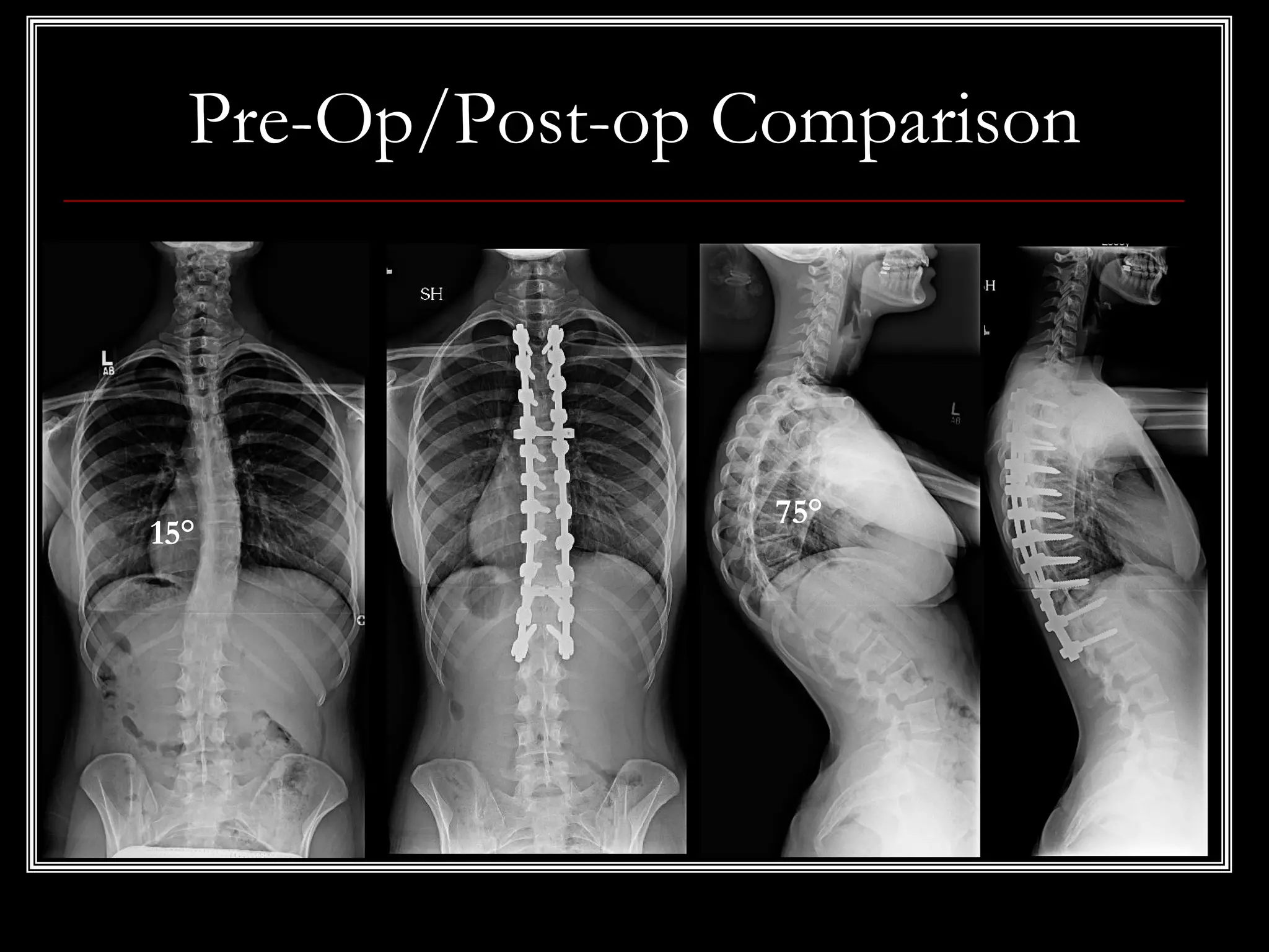 Case Review #9: 19 year old female with Scheuermann's Disease | PPT