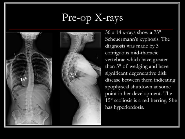 Case Review #9: 19 year old female with Scheuermann's Disease | PPT