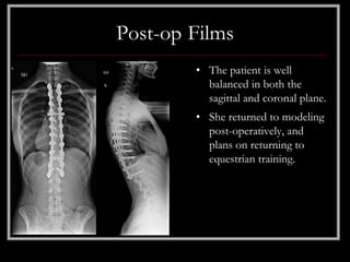 Case Review #9: 19 year old female with Scheuermann's Disease | PDF