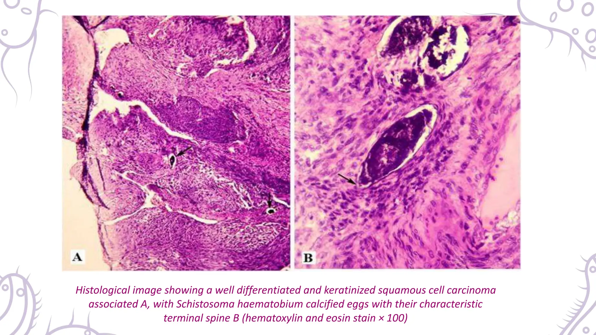 Schistosoma Hematobium and Bladder Cancer..pptx