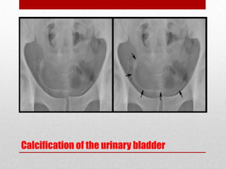Schistosomiasis | PPT