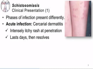 Schistosomiasis Rash