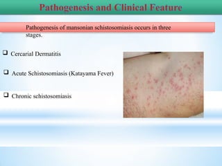 Schistosomiasis_Explaination in parasitology | PPTX