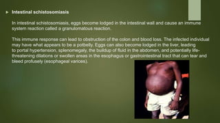Schistosomiasis (hygiene) | PPTX | Digestive Disorders | Diseases and ...