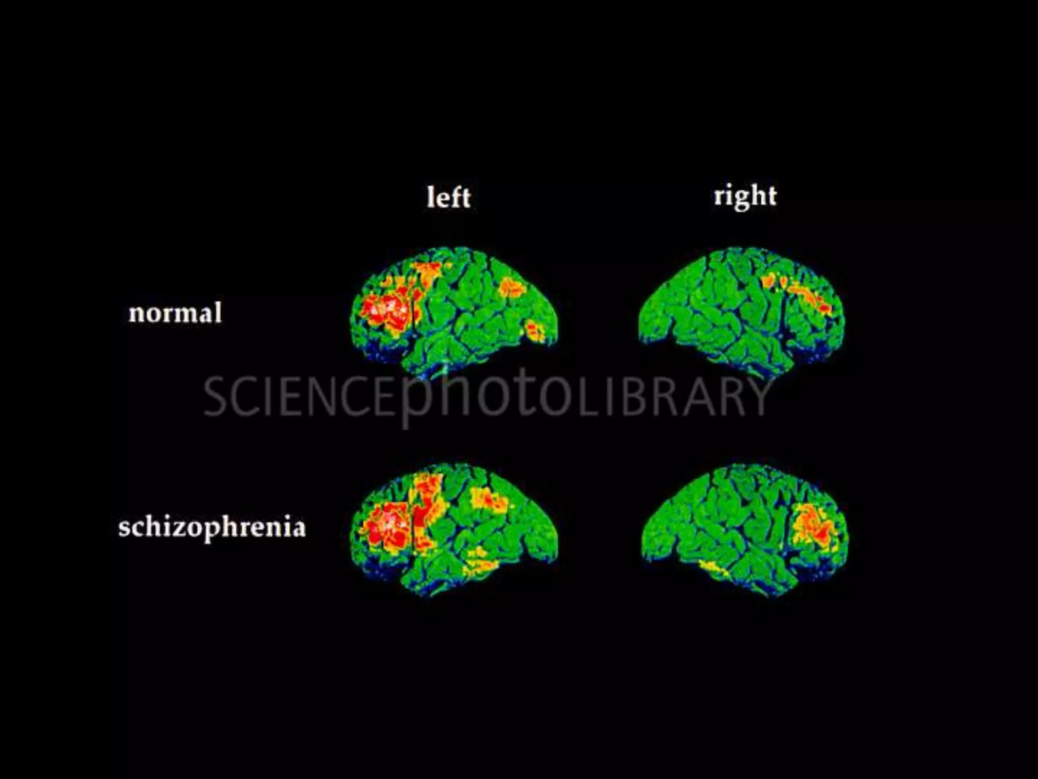 Schizophrenia | PPTX