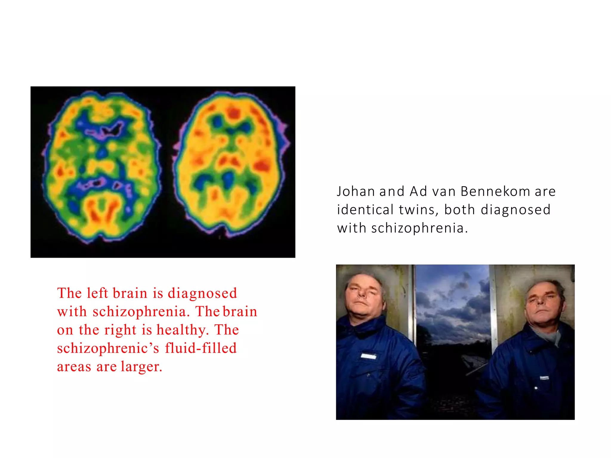 Schizophrenia | PPT