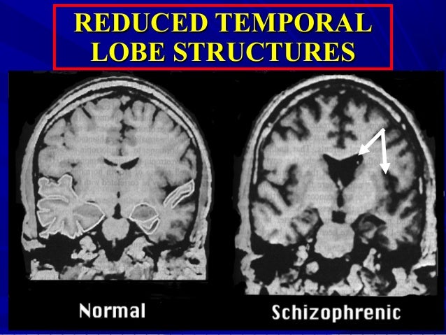 Brain Normal And Schizophrenia
