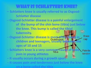 Schlatters knee | PPTX