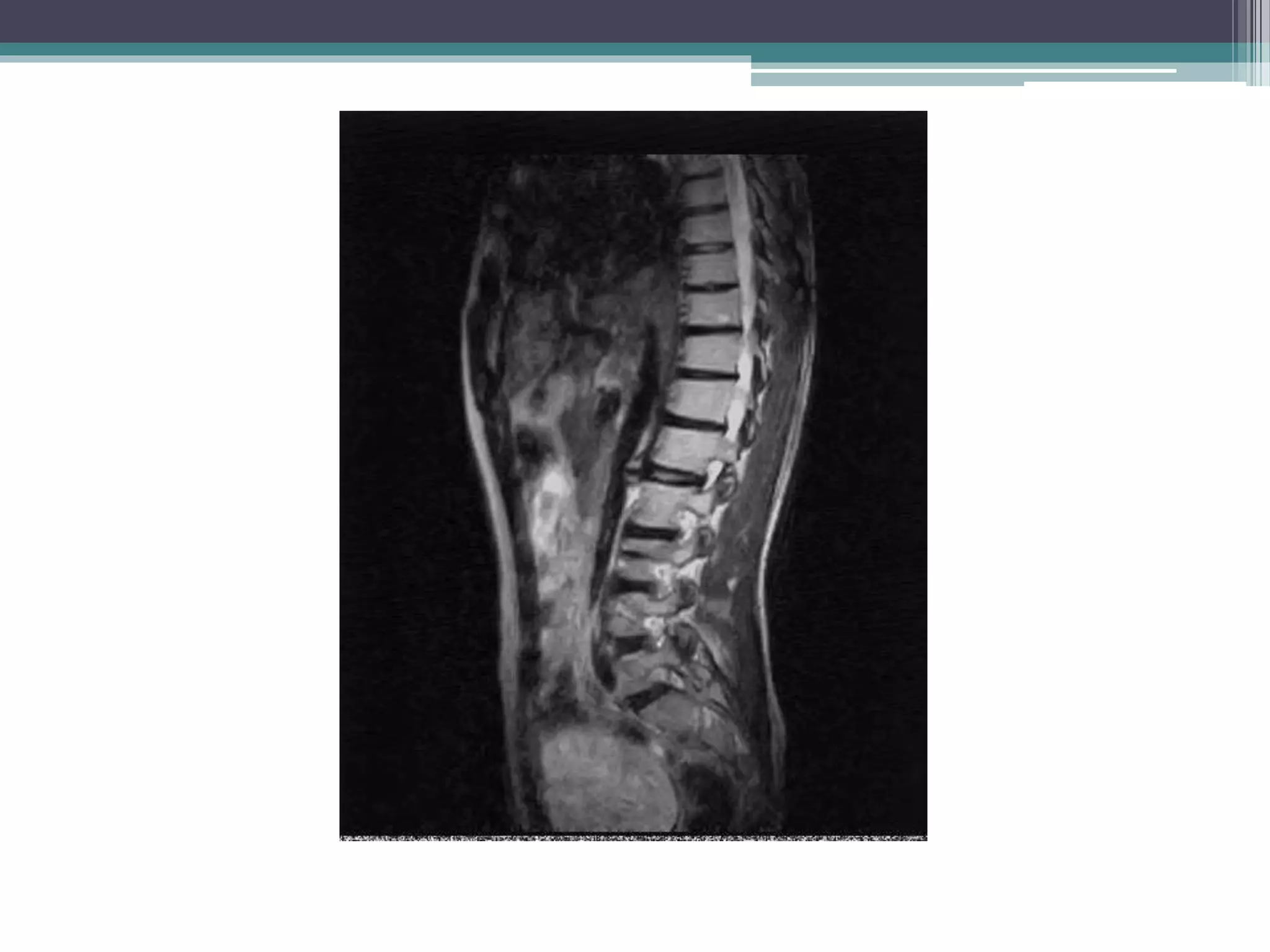 Schmorl’s node case presentation | PPTX